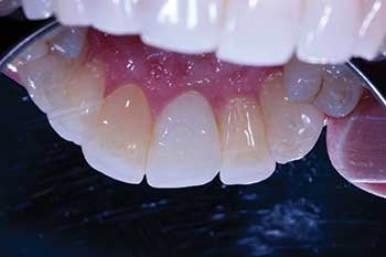 Bleaching Discolored Endodontically Treated Teeth by Dr. Terry Shaw ...