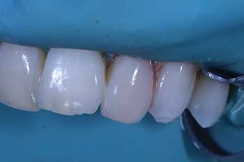 Bleaching Discolored Endodontically Treated Teeth by Dr. Terry Shaw ...