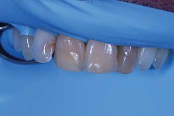 Bleaching Discolored Endodontically Treated Teeth by Dr. Terry Shaw ...