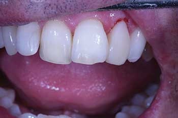 Bleaching Discolored Endodontically Treated Teeth by Dr. Terry Shaw ...