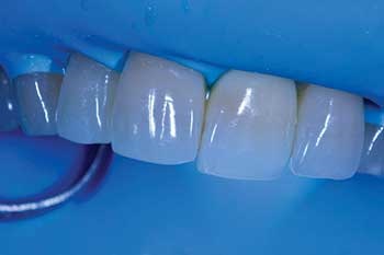 Bleaching Discolored Endodontically Treated Teeth by Dr. Terry Shaw ...