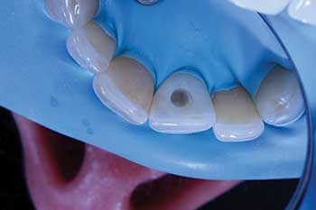 Bleaching Discolored Endodontically Treated Teeth by Dr. Terry Shaw ...