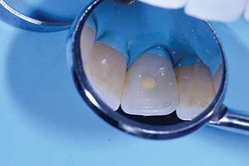 Bleaching Discolored Endodontically Treated Teeth by Dr. Terry Shaw ...