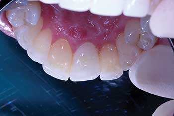 Bleaching Discolored Endodontically Treated Teeth by Dr. Terry Shaw ...