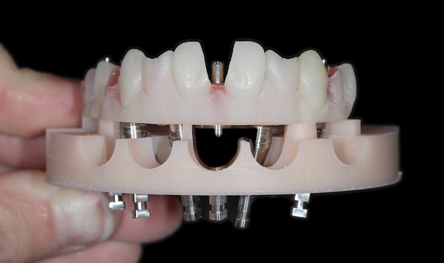 Creating an Affordable, Aesthetic Same-Day Full-Arch Prosthetic by Dr ...
