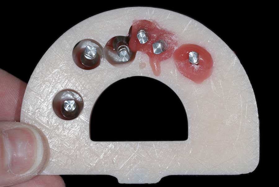 Creating an Affordable, Aesthetic Same-Day Full-Arch Prosthetic by Dr ...