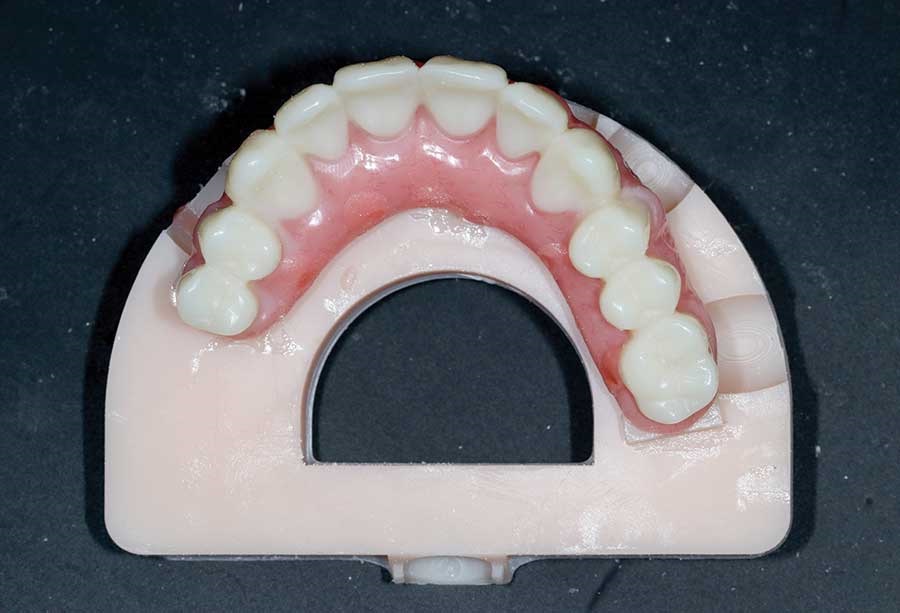 Creating an Affordable, Aesthetic Same-Day Full-Arch Prosthetic by Dr ...