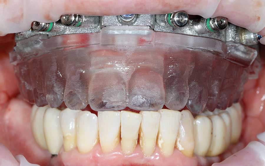 Creating an Affordable, Aesthetic Same-Day Full-Arch Prosthetic by Dr ...
