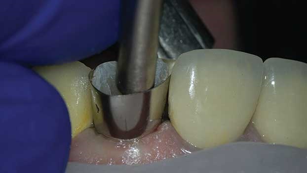 Show Your Work: Strike Up the Band! by Dr. Arthur R. Volker - Dentaltown