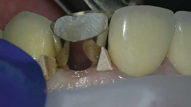 Show Your Work: Strike Up the Band! by Dr. Arthur R. Volker - Dentaltown