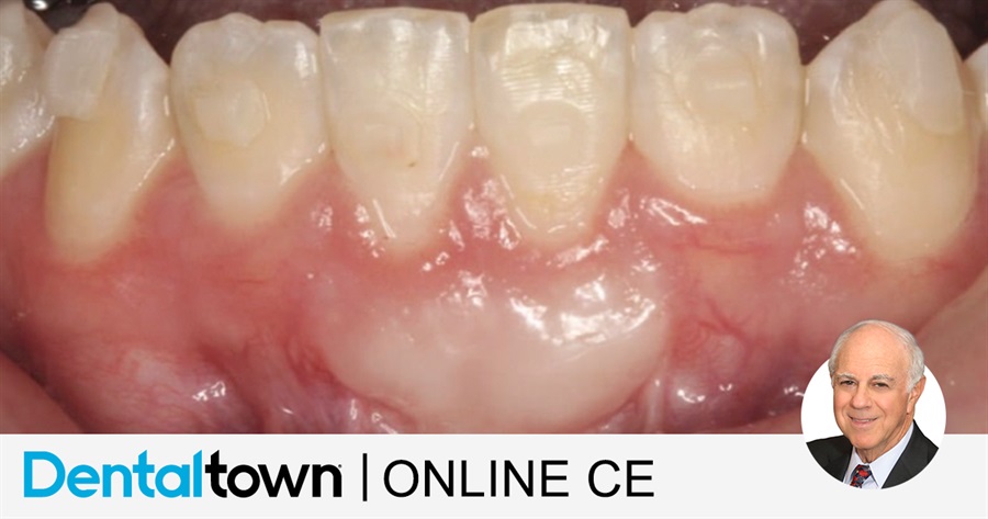 Improving Restorative Results with Soft Tissue Grafting by James Kohner ...