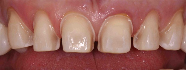 Anterior Veneer Prep for Closing Black Triangles - Clinical Mastery ...