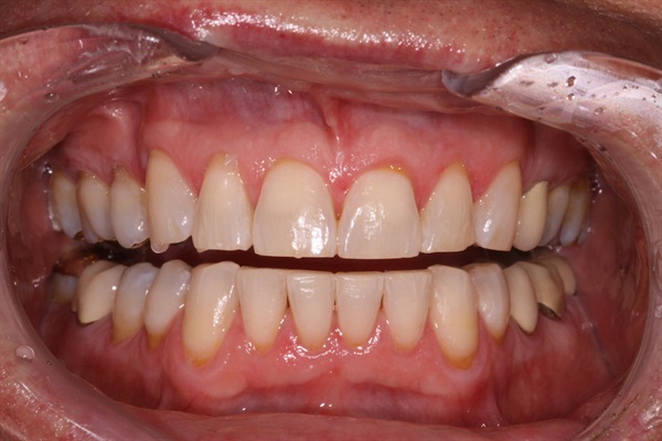 Anterior Veneer Prep for Closing Black Triangles - Clinical Mastery ...