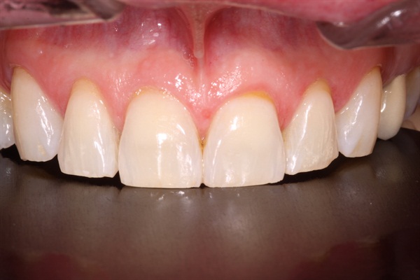 Anterior Veneer Prep for Closing Black Triangles - Clinical Mastery ...