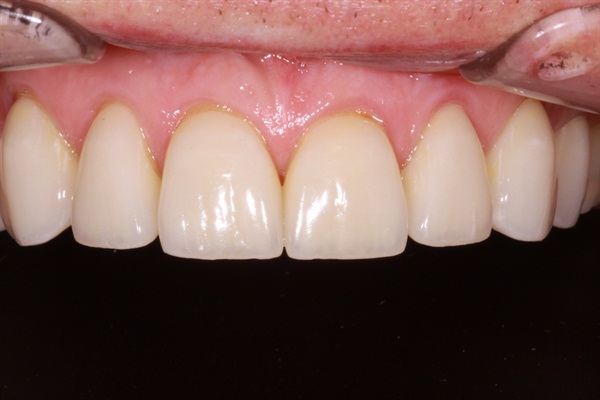 Anterior Veneer Prep for Closing Black Triangles - Clinical Mastery ...