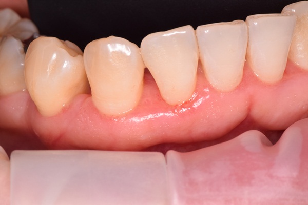 Vertical Perio infrabony defect-part 1 treated with A-PRF, I-PRF ...