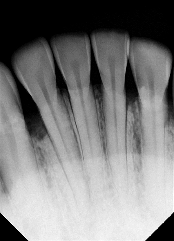 Vertical Perio infrabony defect-part 1 treated with A-PRF, I-PRF ...