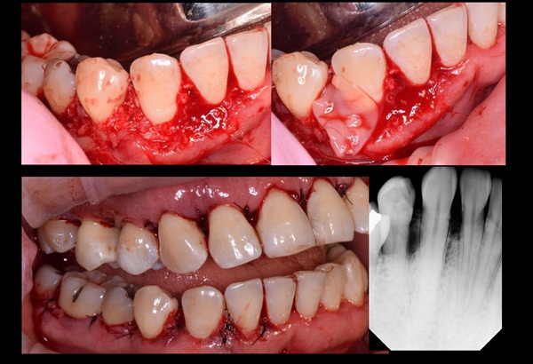 Vertical Perio infrabony defect-part 1 treated with A-PRF, I-PRF ...