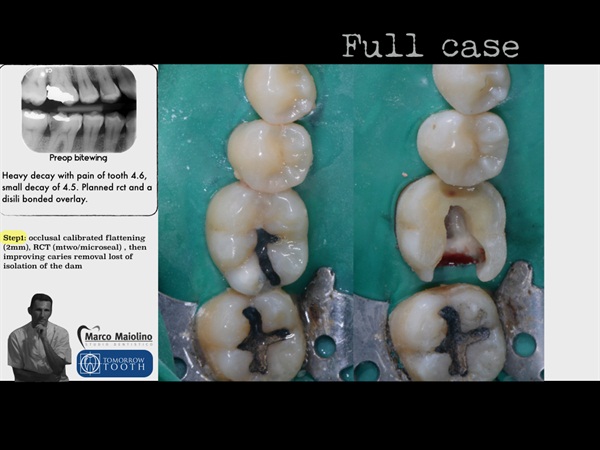 Overlay on molar after RCT - Maiolino's blog - Dentaltown